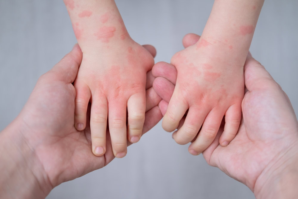 Understanding Paediatric Infant Psoriasis | Dermal Therapy