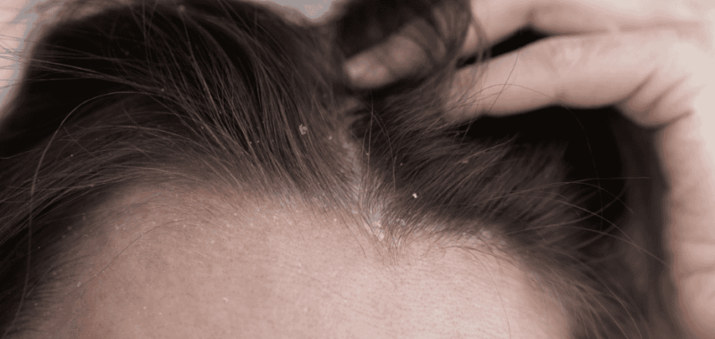 Causes of Itchy Scalp: Common Triggers and Remedies